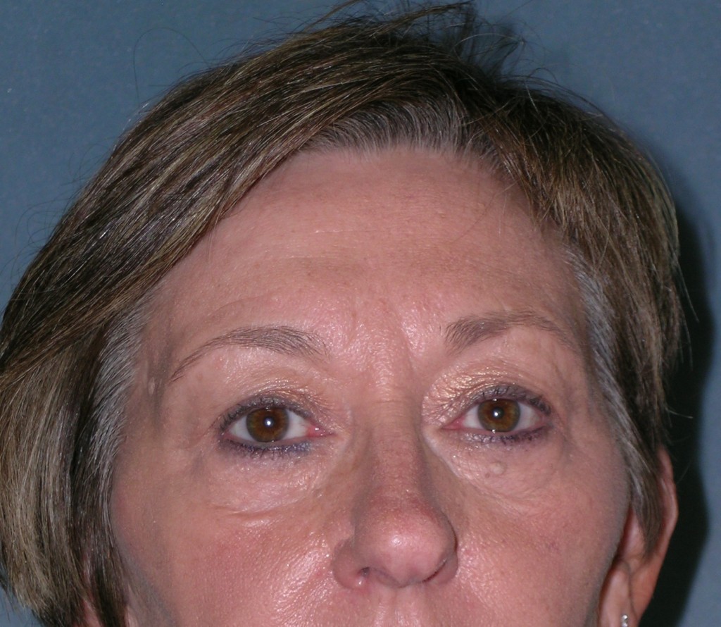 Endoscopic Forehead Lift Before & After Photos | Medhi Balakhani MD